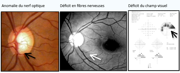 Glaucome - Atrium Vision