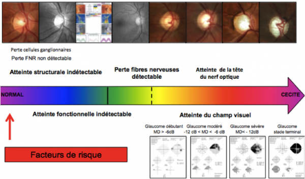 Glaucome - Atrium Vision